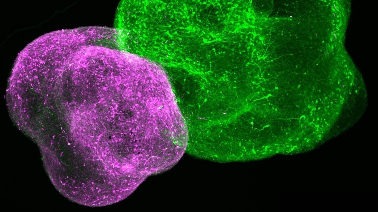 Scientists restore brain cells impaired by a rare genetic disorder | WAMU